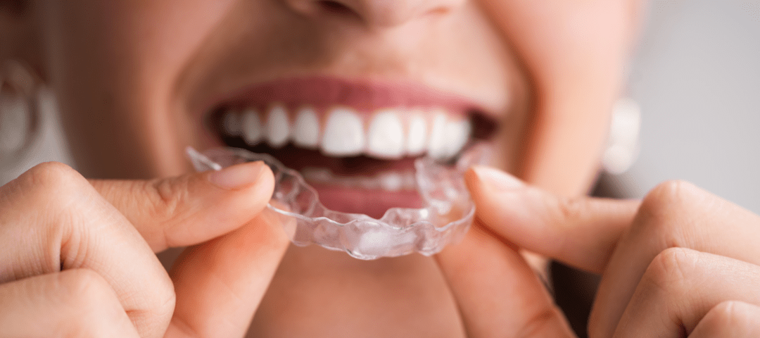 Retenedores dentales: ¿Para qué son necesarios?