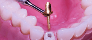 Perno dental: ¿En qué consiste?