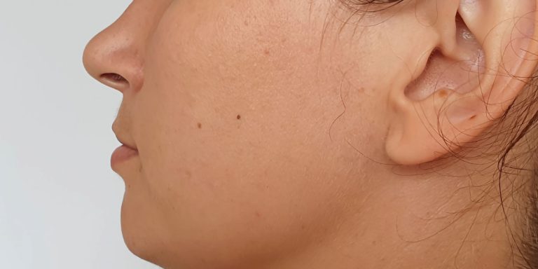 Micrognatia: Causas y tratamiento