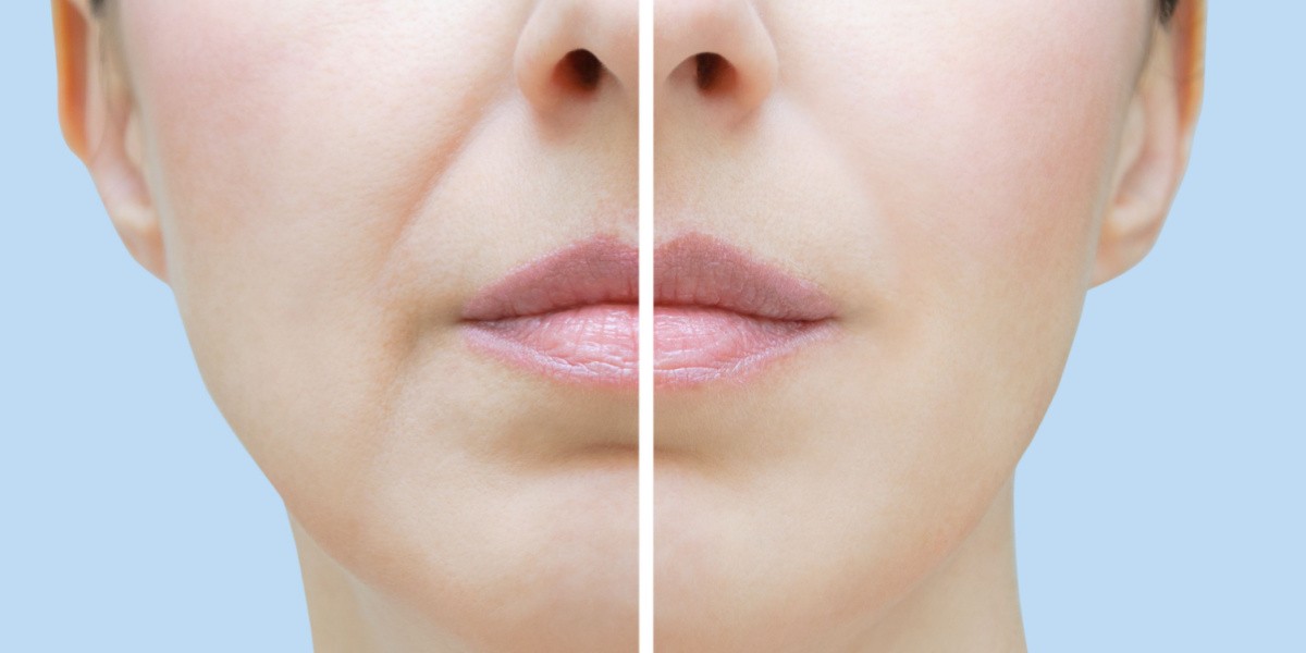 Surco nasogeniano: Eliminar las arrugas de esta zona