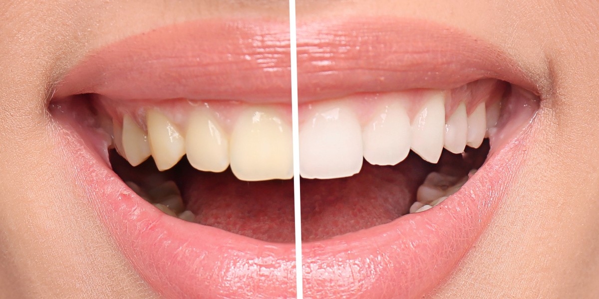 Dientes amarillos: Causas y tratamiento