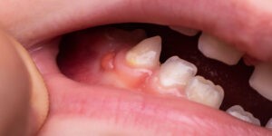 Epulis: ¿En qué consisten?