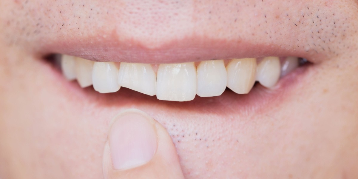 Diente astillado: ¿Qué hacer en estos casos?