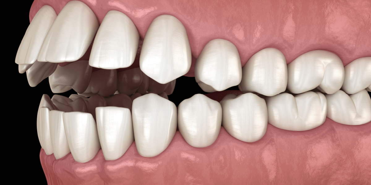 Mordida abierta: Sus características