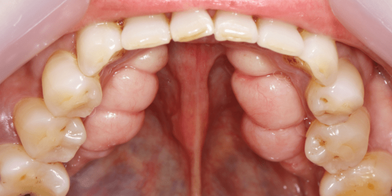 Torus: Causas, efectos, tratamiento y prevención