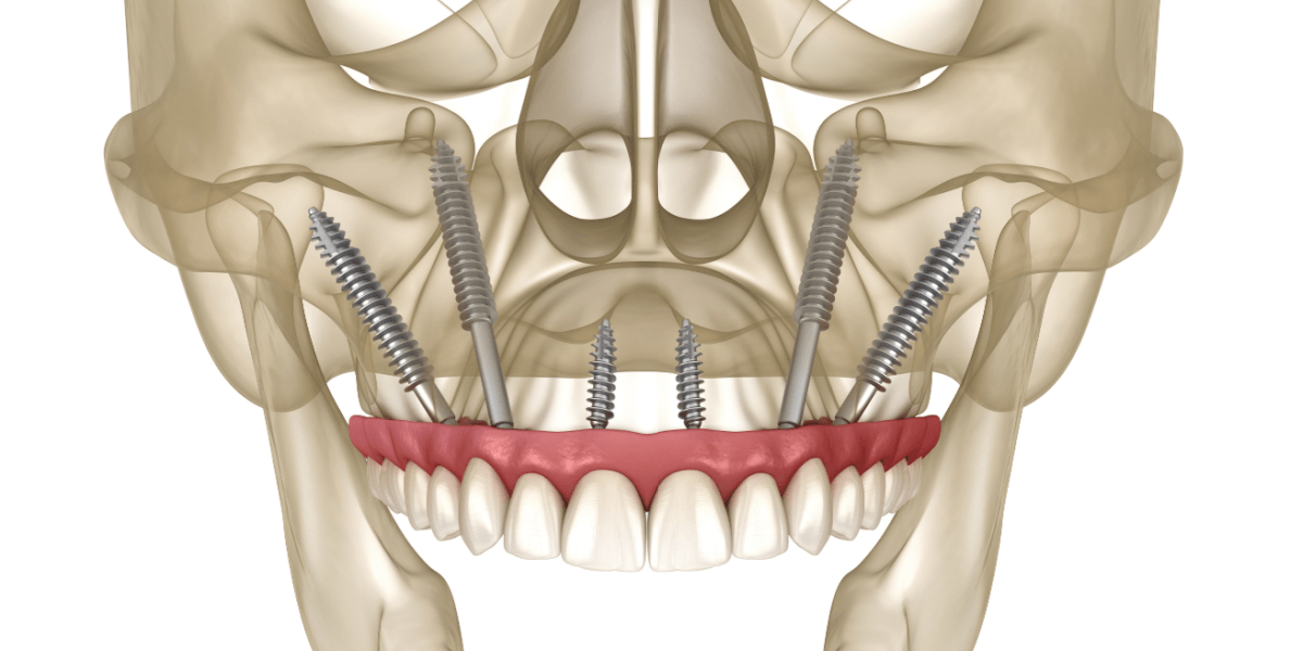 Arc zigomàtic: La seva importància en implantologia