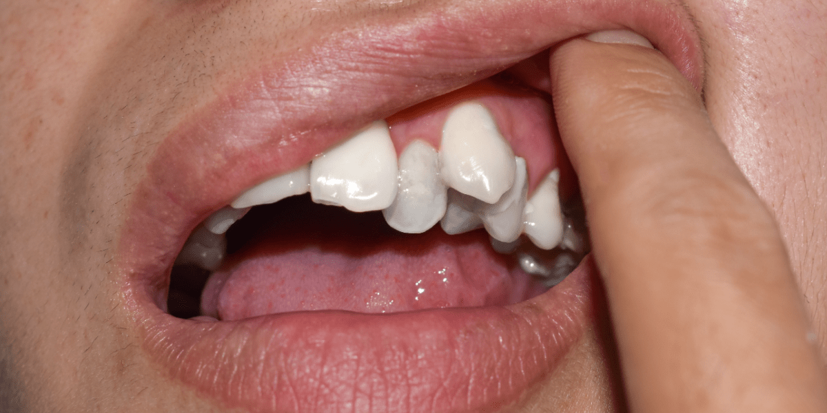 Hiperdoncia Supernumerarios – Dr. Manuel López – Cirujano