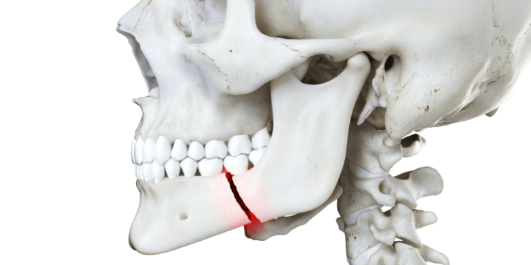 Fractura mandibular: ¿Cómo actuar en estos casos?