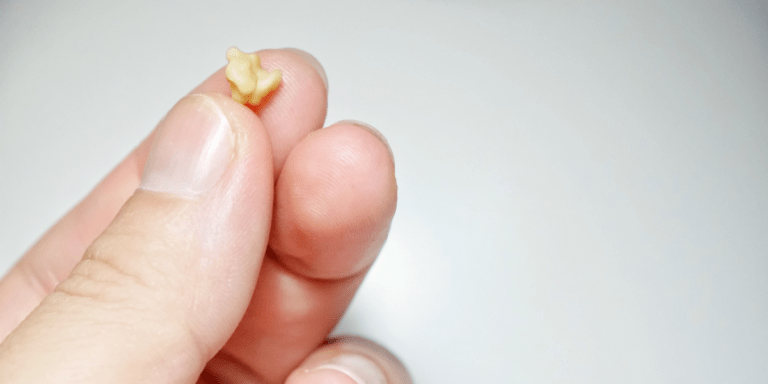 Tonsilolitos: ¿Qué son?