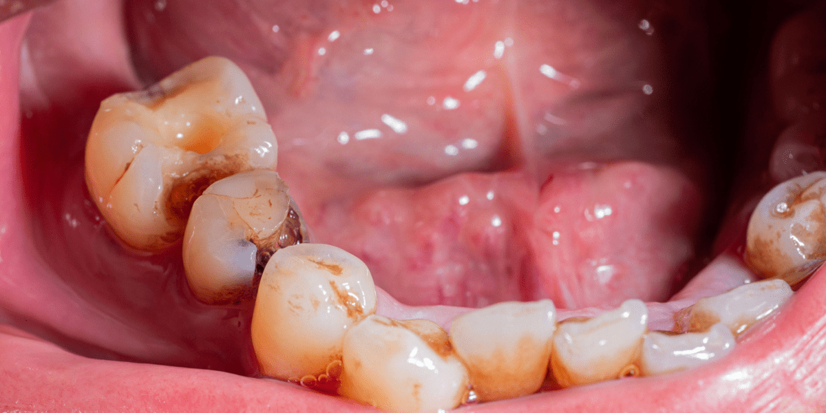 Caries Dental Etapas Tempranas Tipos De Caries Dentales | Clínica