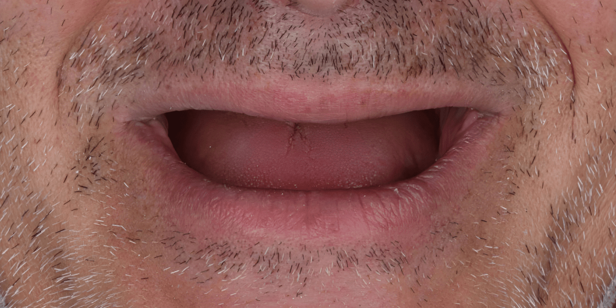 Edentulismo: ¿De qué se trata?