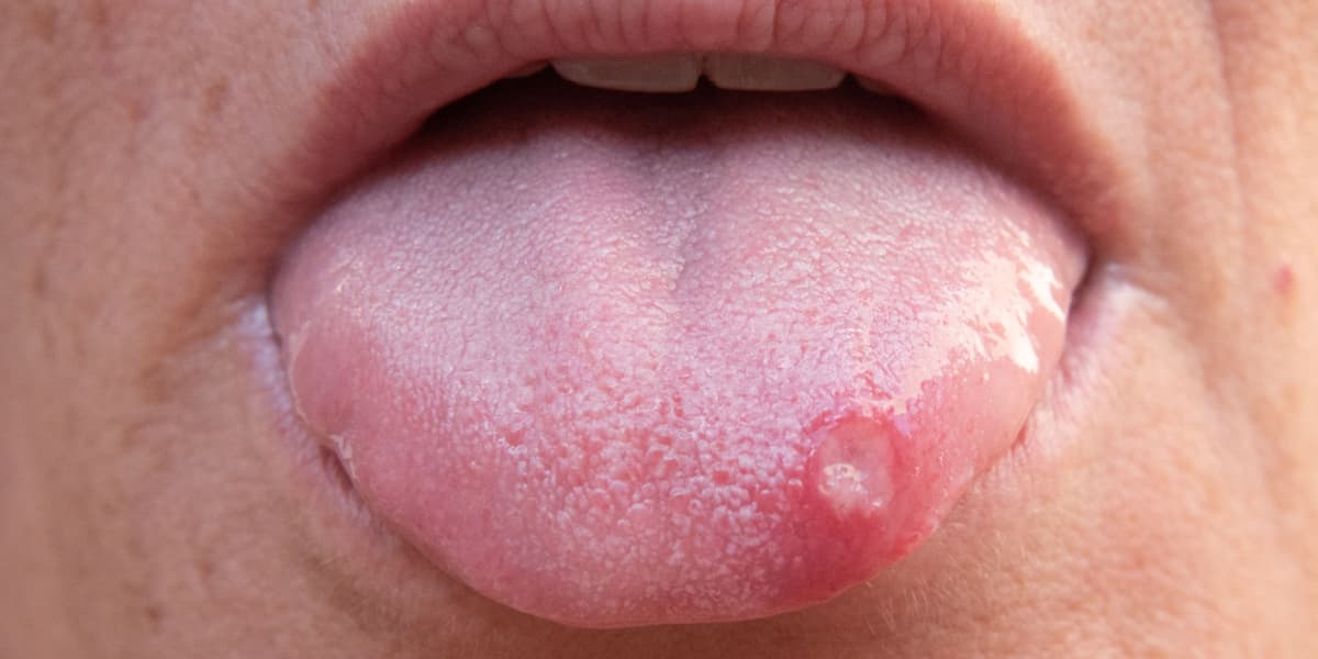 Llagas en la lengua: ¿Por qué aparecen?