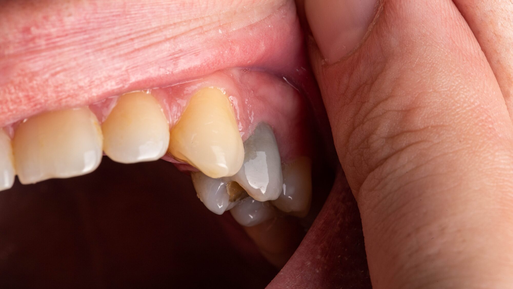 Dientes negros: sus causas y efectos en la salud y estética bucodental