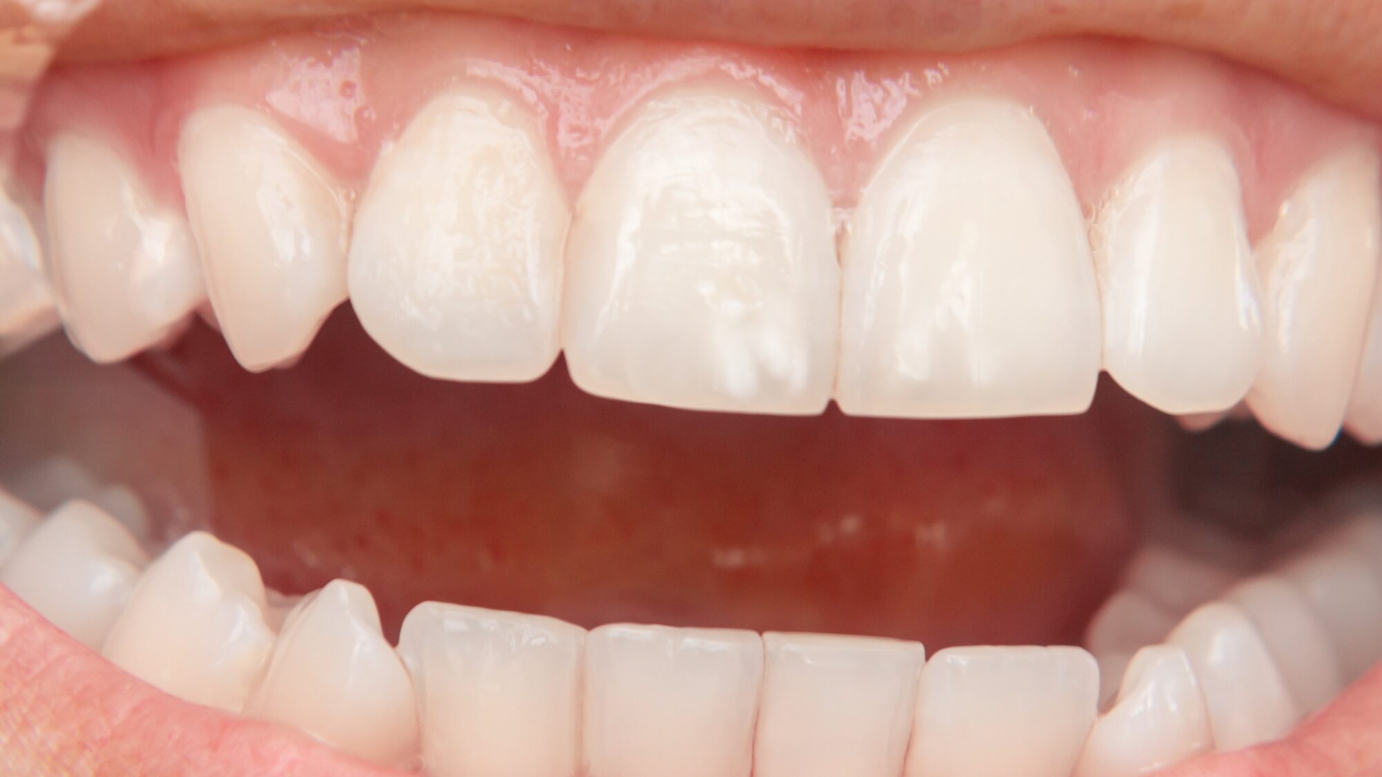 Fluorosis: guía completa sobre este problema